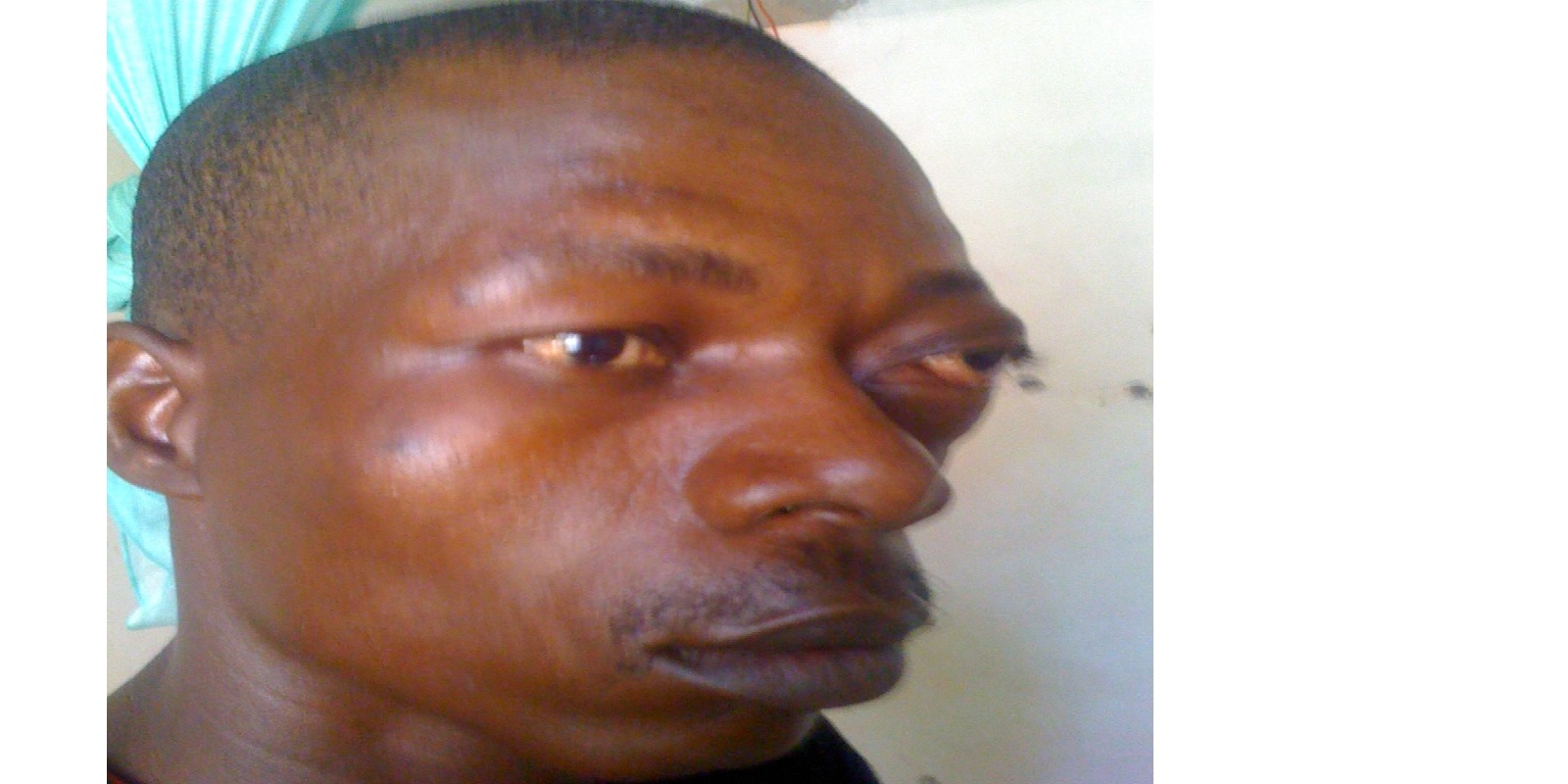 Face Of Zimbabwean Man Deformed By Botswana Police Looks Different Now ...